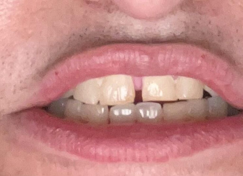 Custom Partials & Full Dentures - Missing Tooth & Teeth Online Denture ...