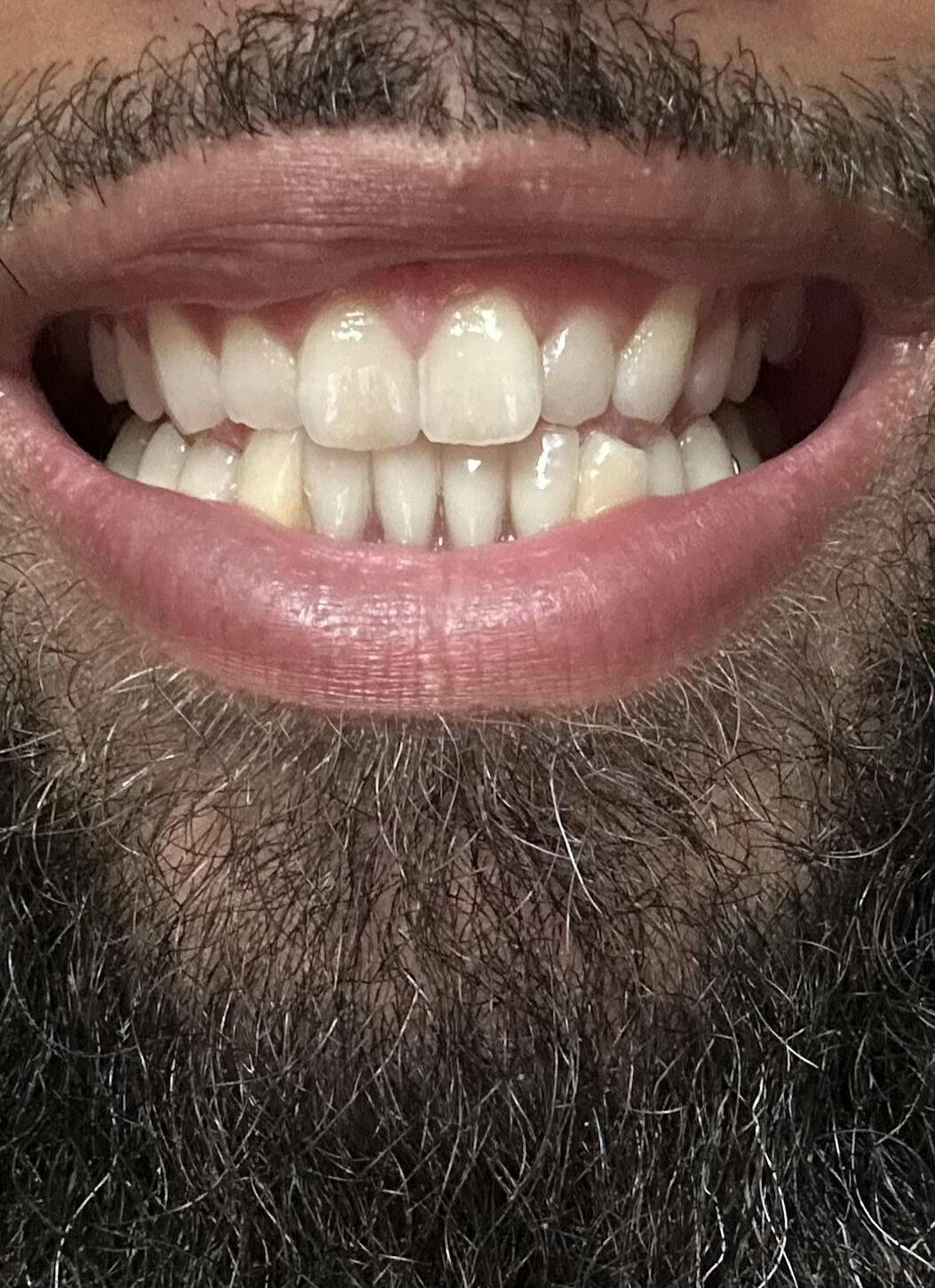 Online Custom Flipper Acrylic Partial Upper Lower Denture – PatrickDeanDent