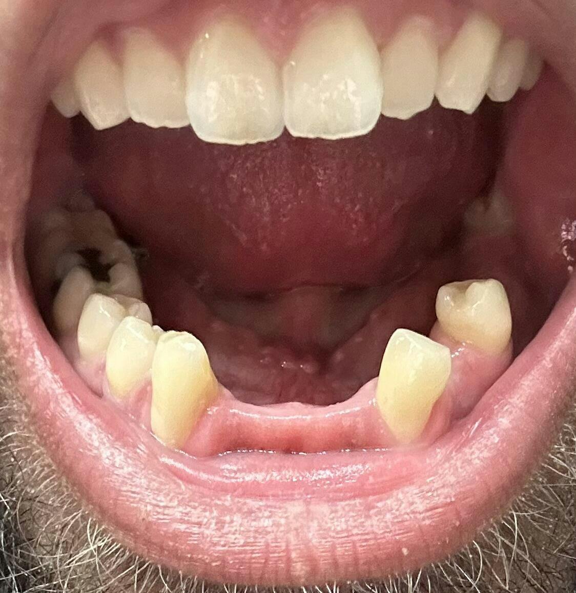 Custom Partials & Full Dentures - Missing Tooth & Teeth Online Denture ...