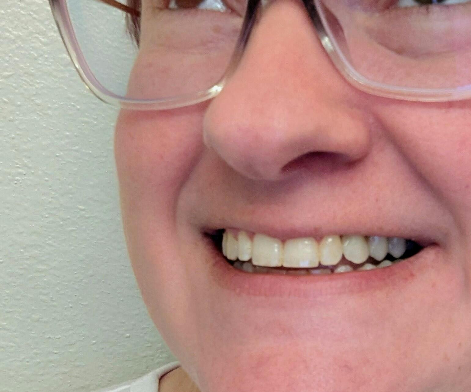 Custom Partials & Full Dentures - Missing Tooth & Teeth Online Denture ...