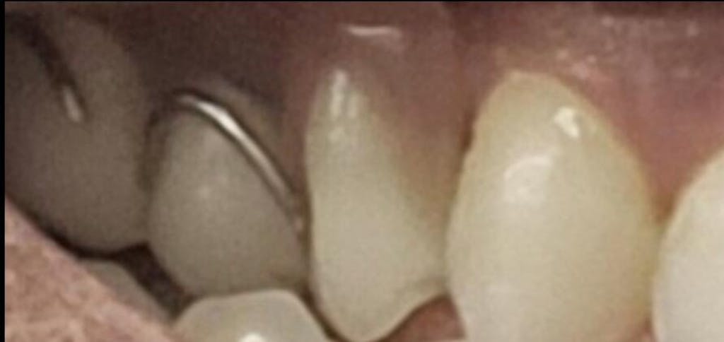 Custom Partials & Full Dentures - Missing Tooth & Teeth Online Denture ...