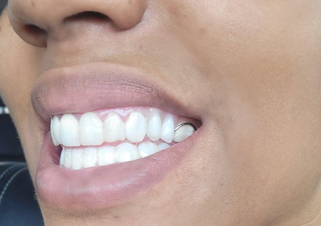 Custom Partials & Full Dentures - Missing Tooth & Teeth Online Denture ...