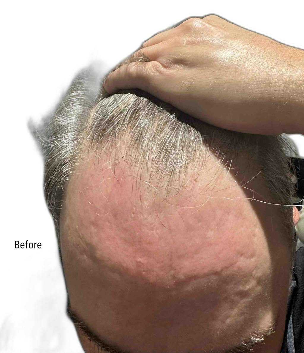 RevivHair™ Max Stimulating Serum with 5% Redensyl & RCP for thinning ...