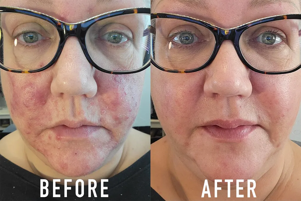 Redness Control Trio | Riversol Dermatologist Developed Skincare