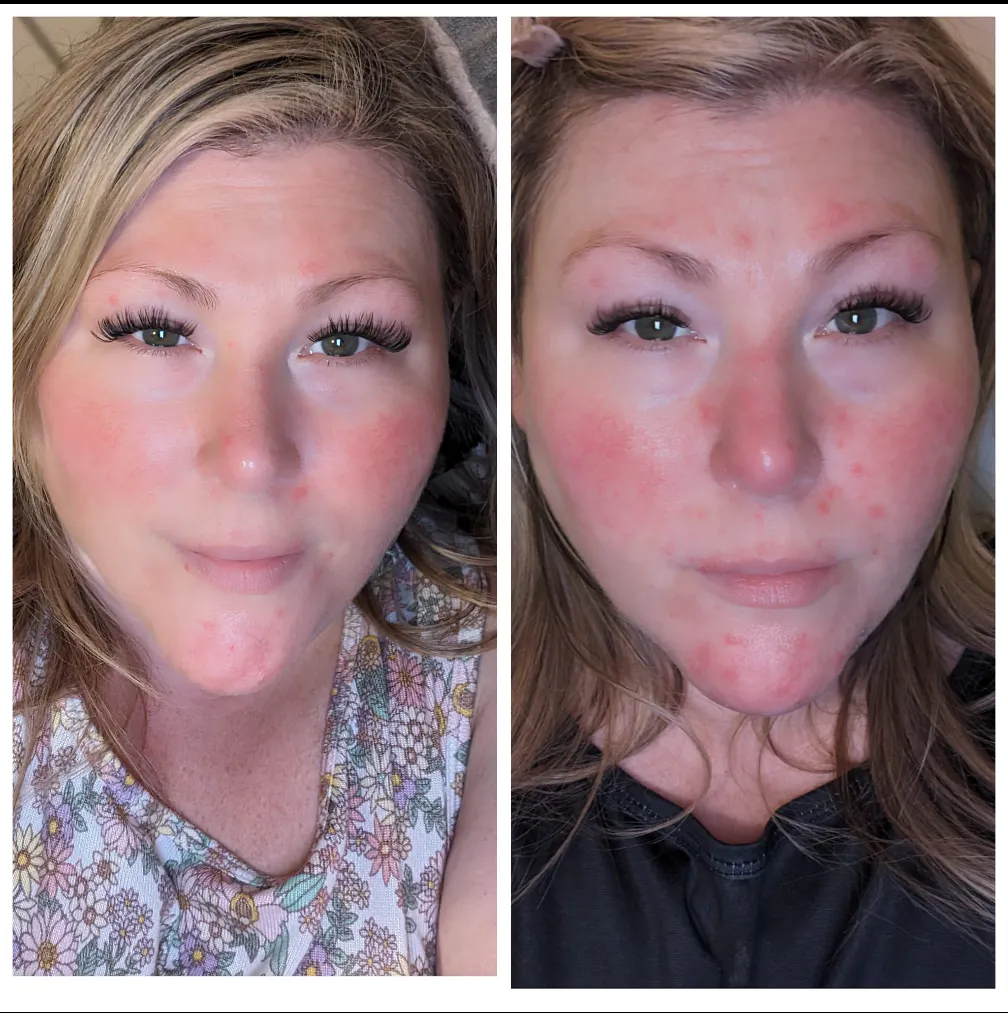 Redness Control Trio and Peel | Riversol Derm Developed