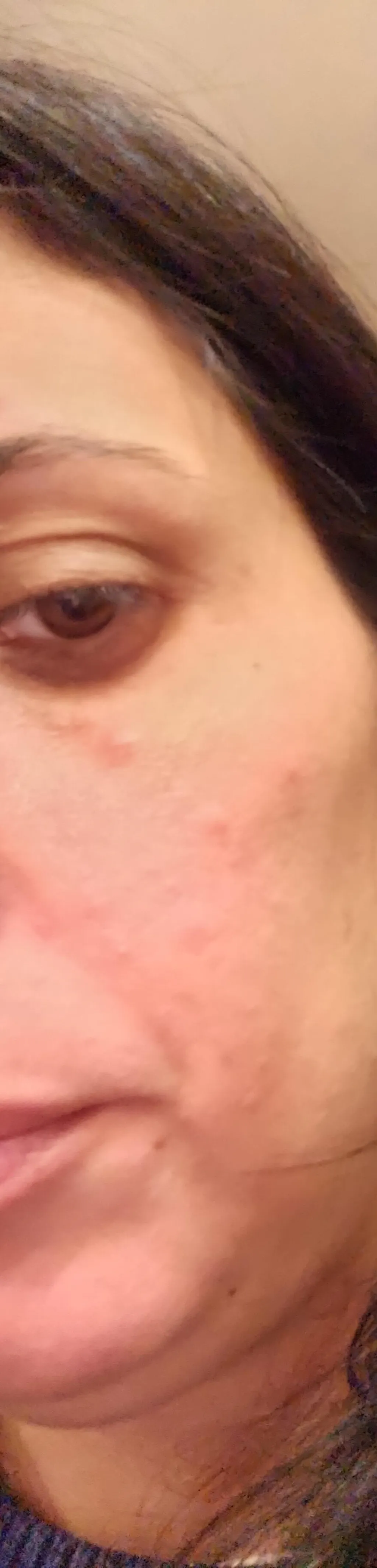 Anti-Redness Serum For Rosacea Prone Skin - Riversol Dermatologist ...