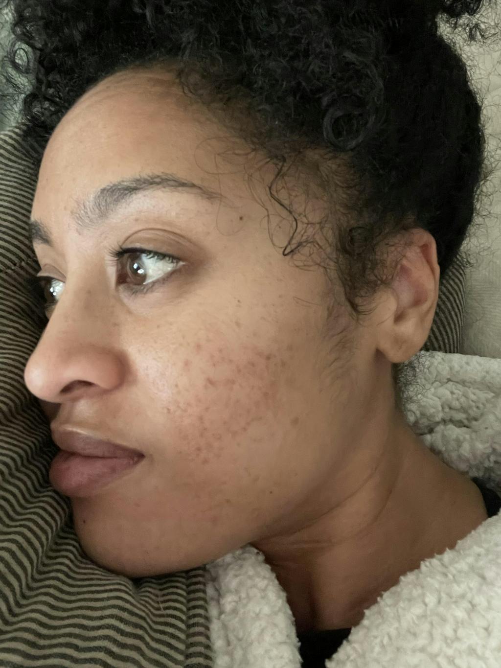 Dr Vanita Rattan TRIO Blemish PM Gel Moisturiser | Oily Acne Skin ...