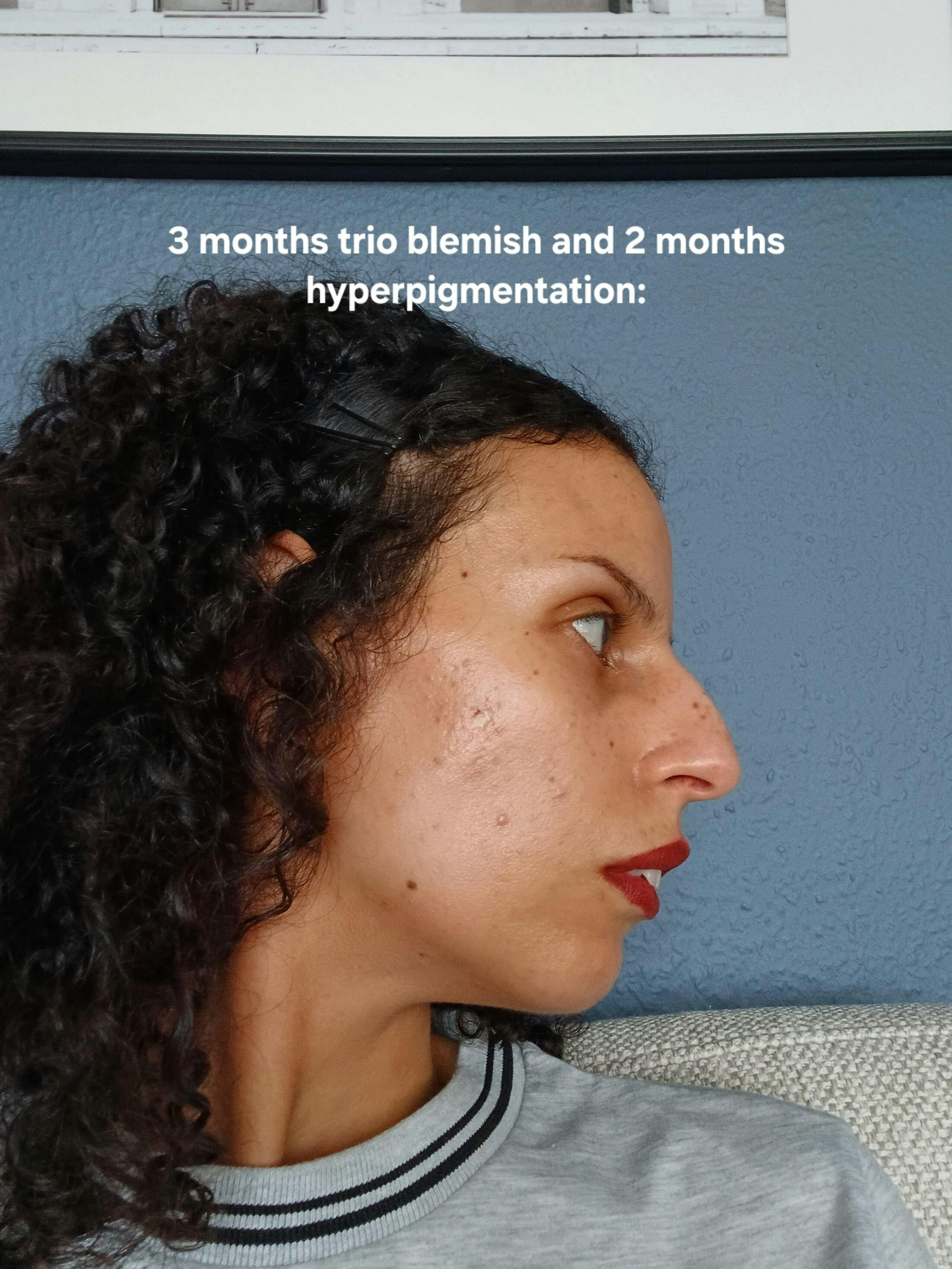 Complete Dr. V TRIO Blemish Range | Oily Skin & Acne Prone Skin ...