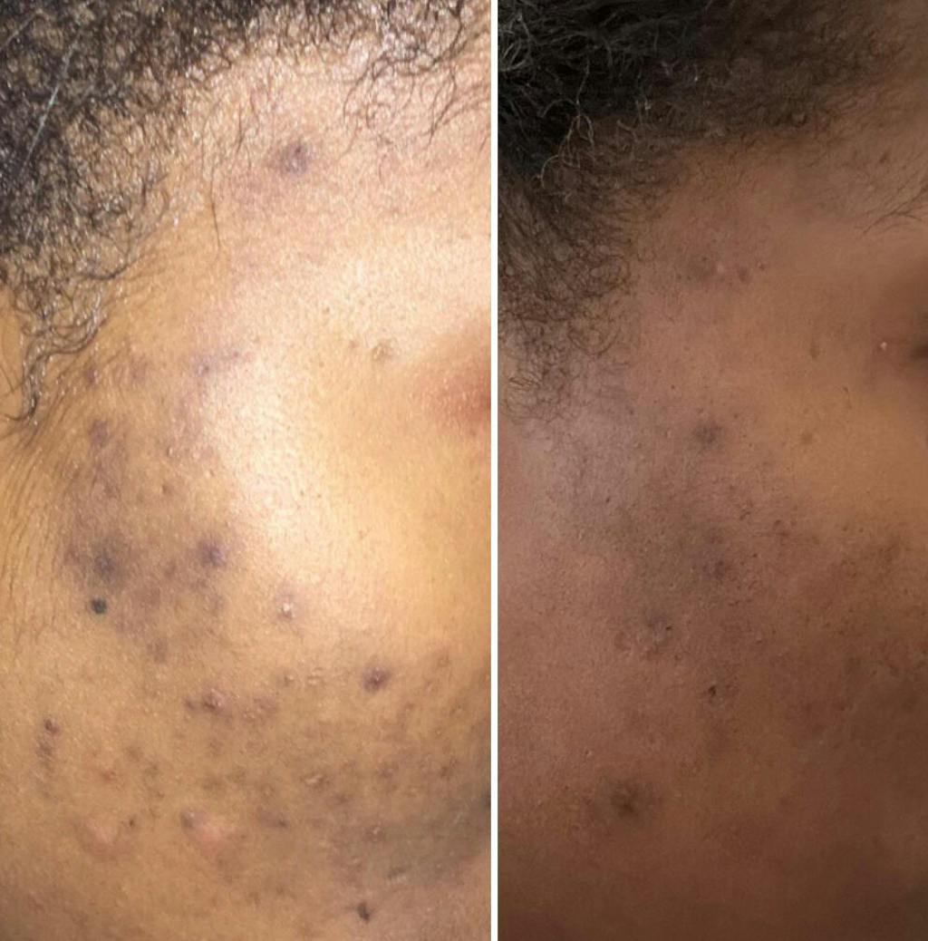 TRIO Blemish Face Wash | Oily Skin & Acne Prone Skin. – Skincare by Dr V