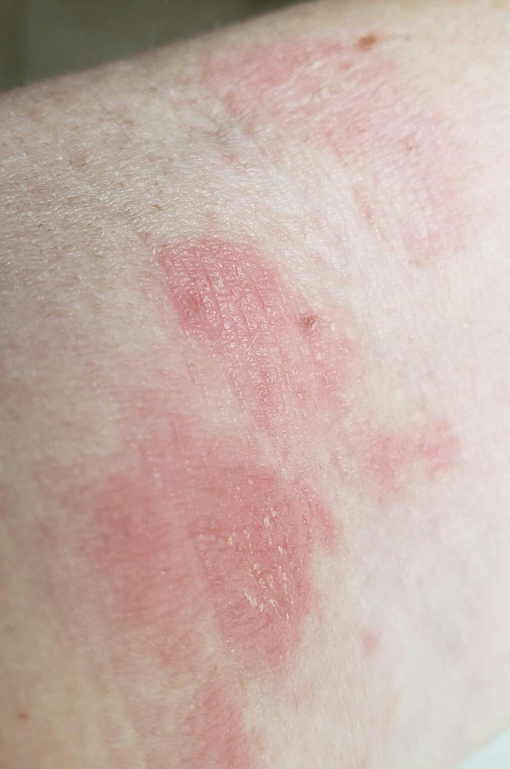 Skinesa® | Best Probiotic Supplements for Skin Health | Probiotic Pills ...