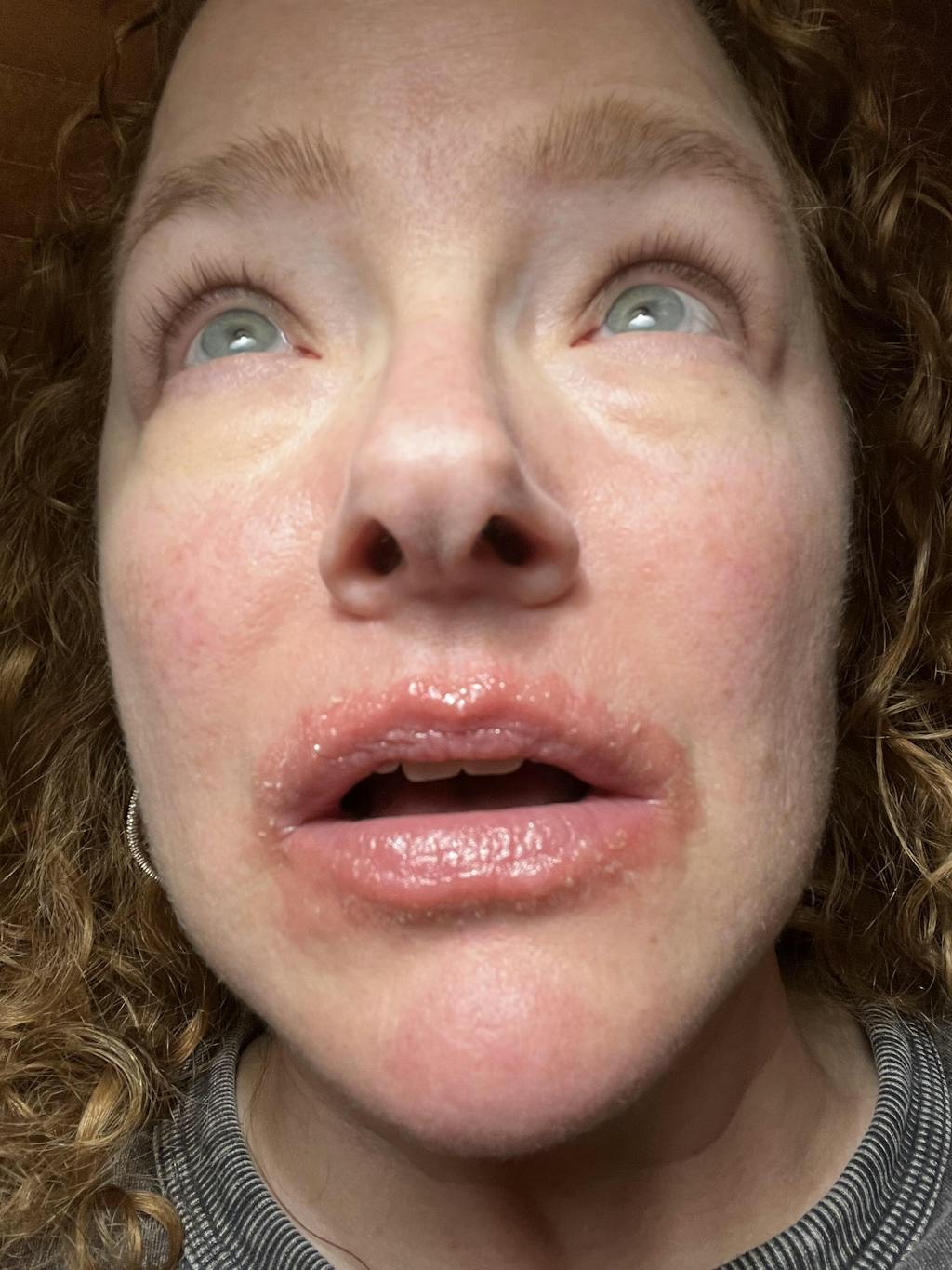 Skinesa® | Best Probiotic Supplements for Skin Health | Probiotic Pills ...