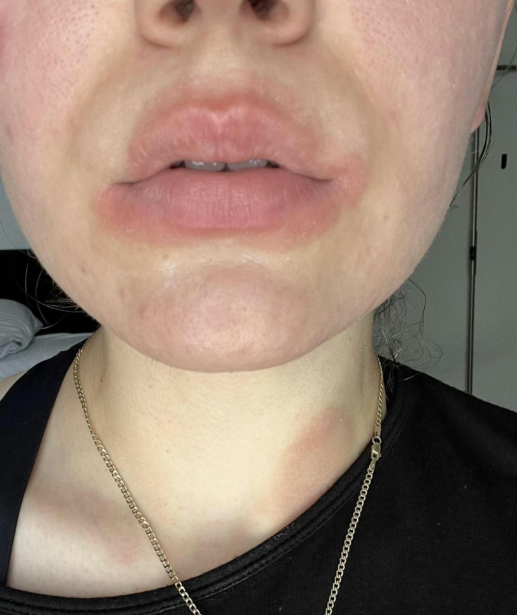 Skinesa® | Best Probiotic Supplements for Skin Health | Probiotic Pills ...