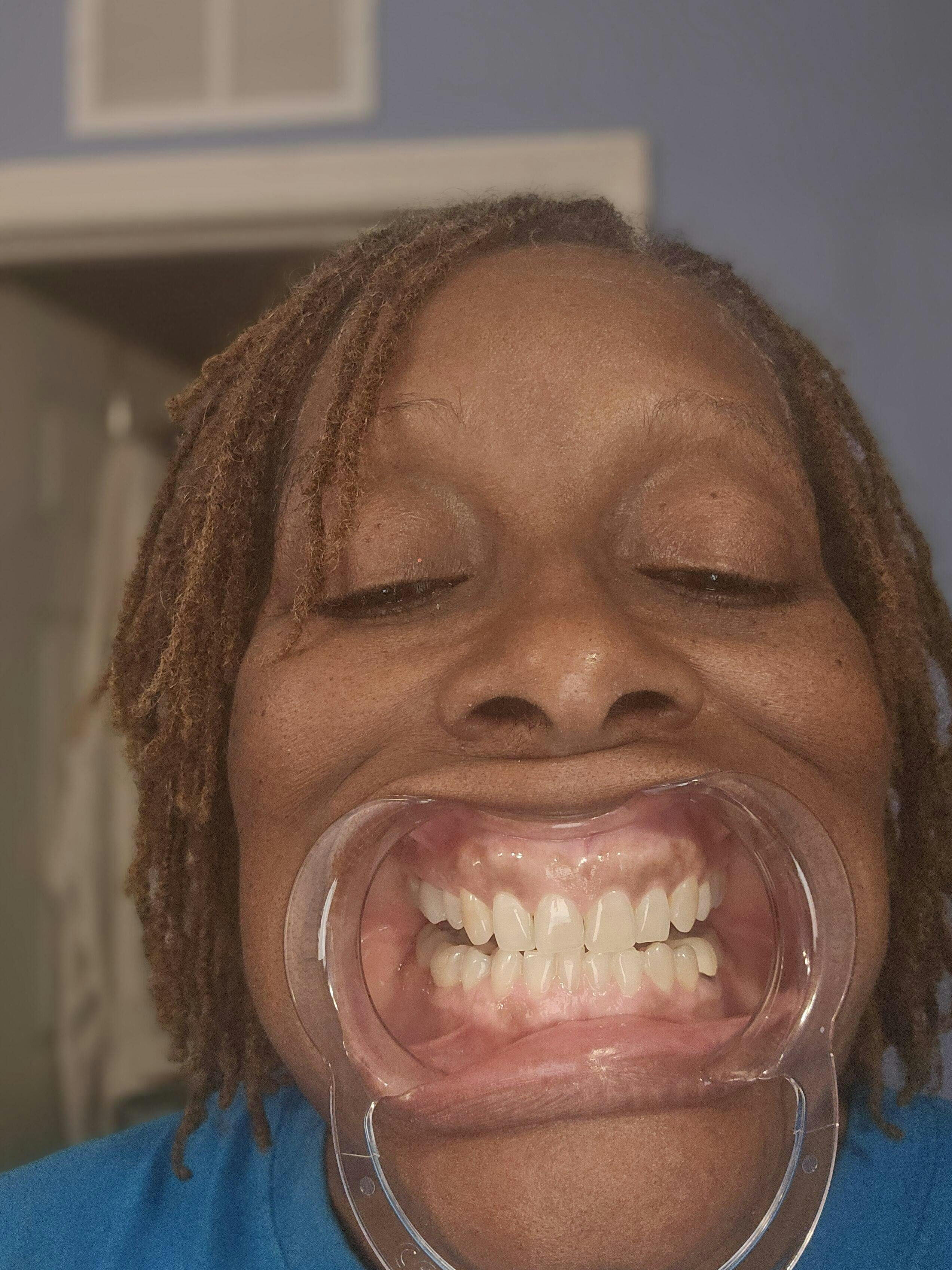 Clear Retainers + Impression Kit – SmileSet