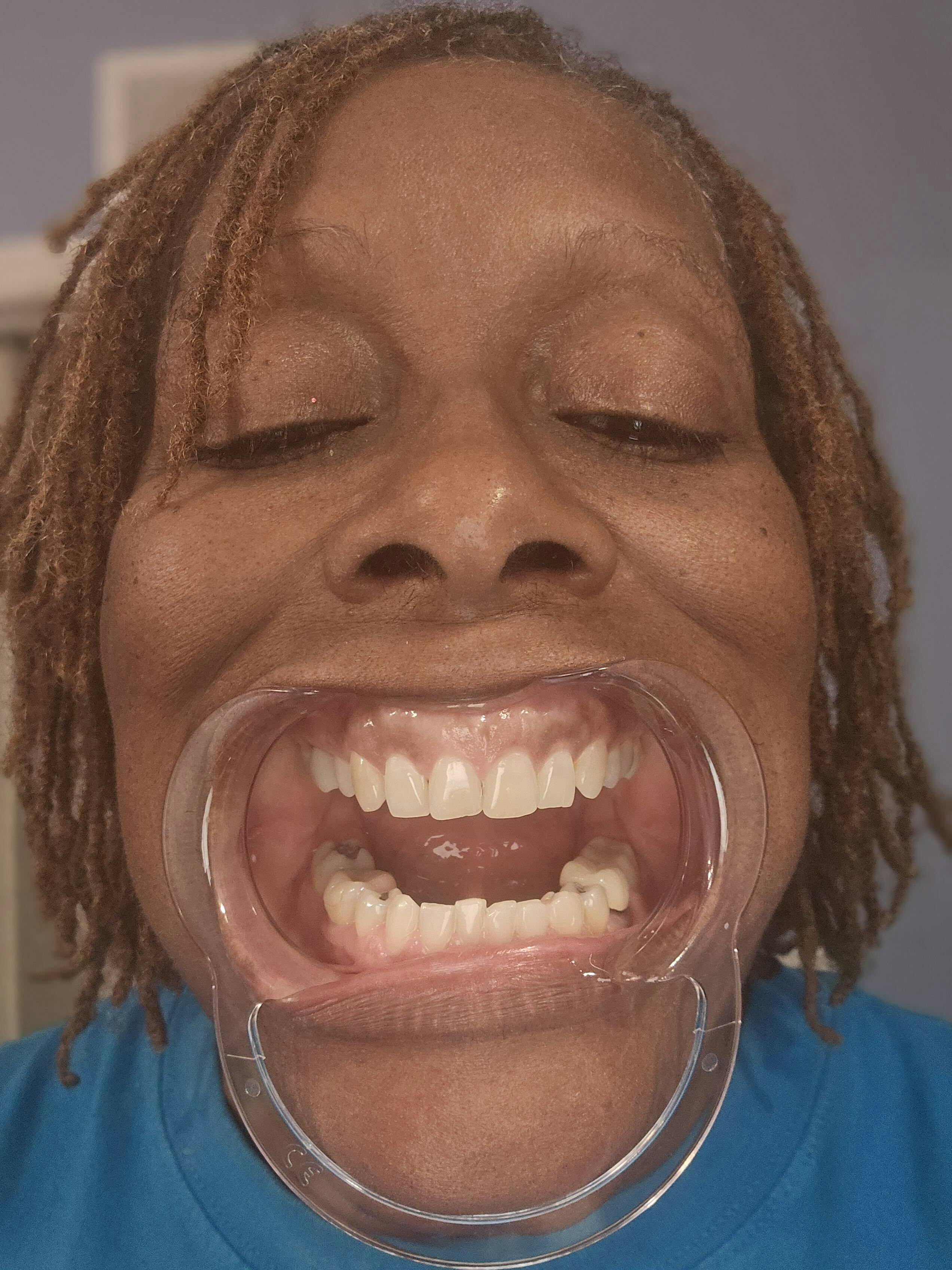 Clear Retainers + Impression Kit – SmileSet