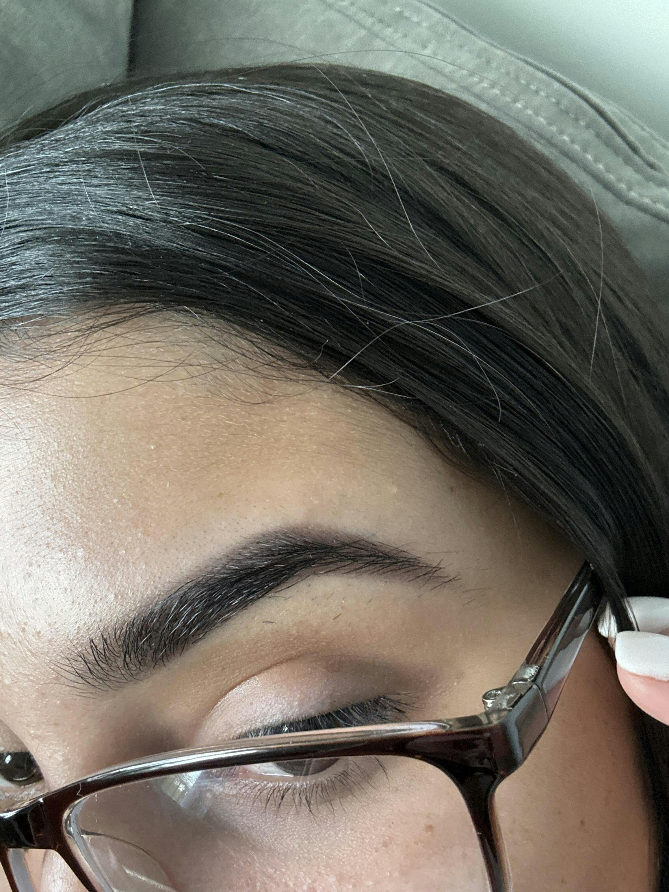 What is eyebrow dandruff? - Supercilium - Supercilium EU