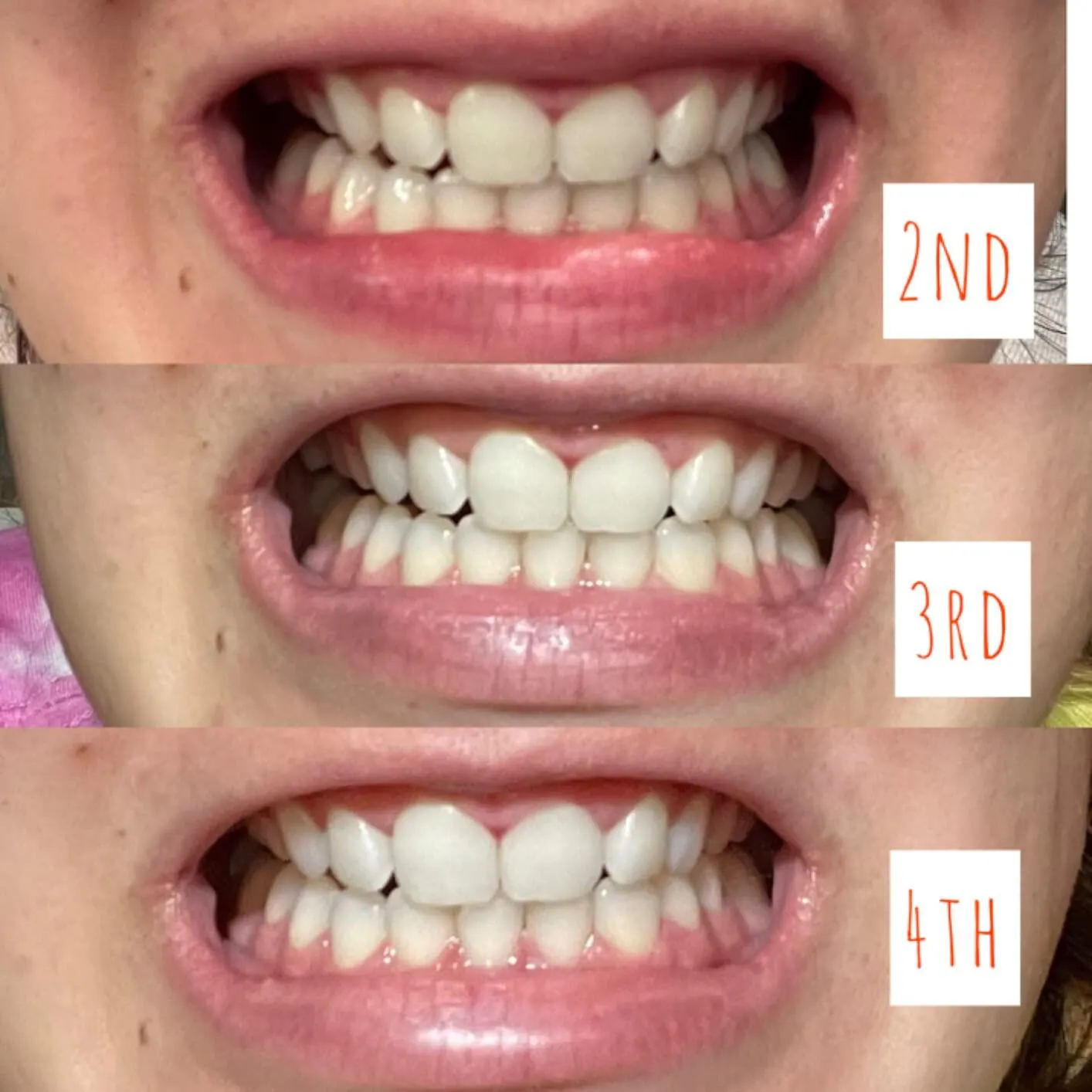 Buy Philips Zoom DayWhite 9.5% | The White Smiles