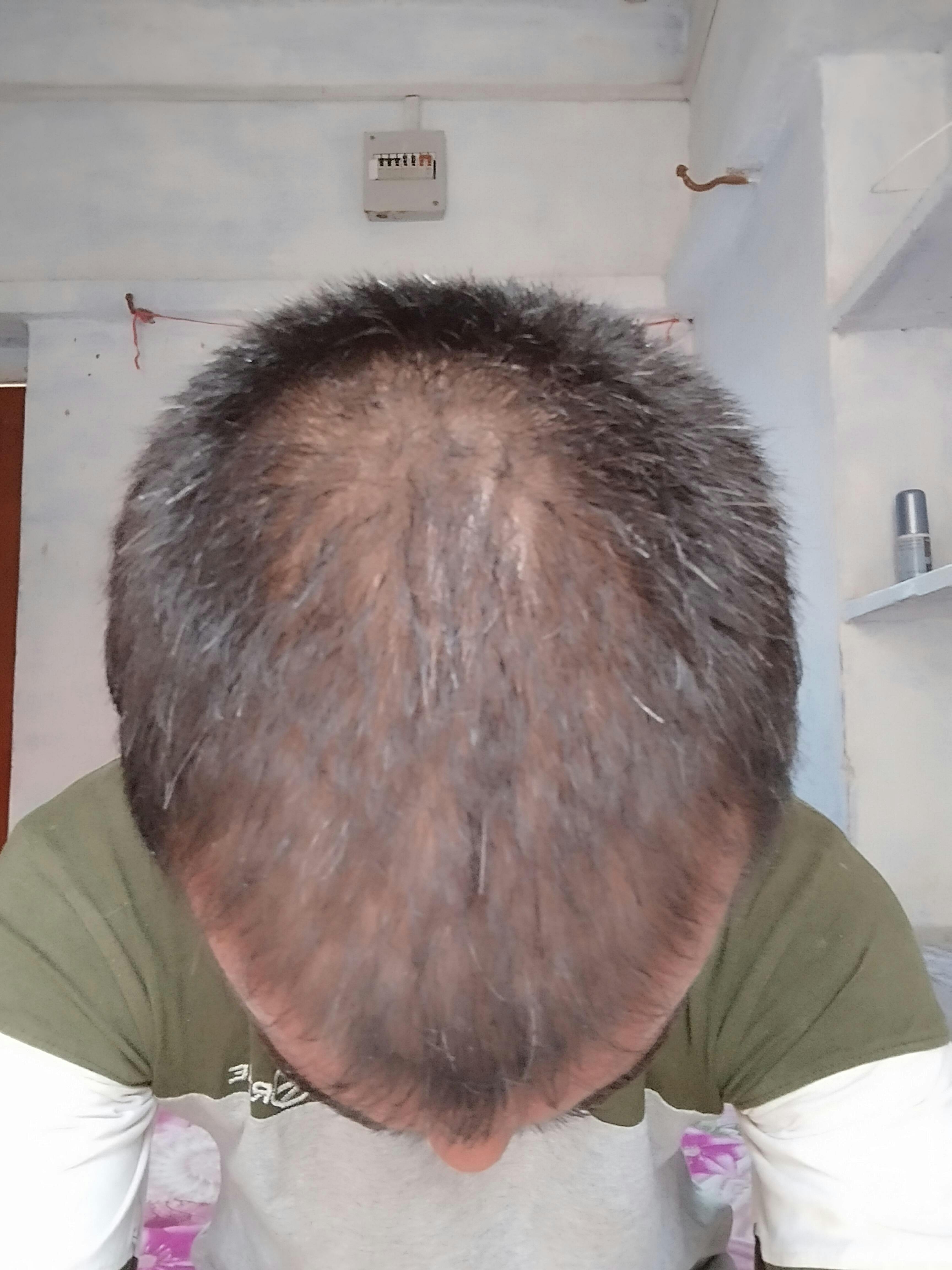 Traya hair review | Traya review | Traya Health