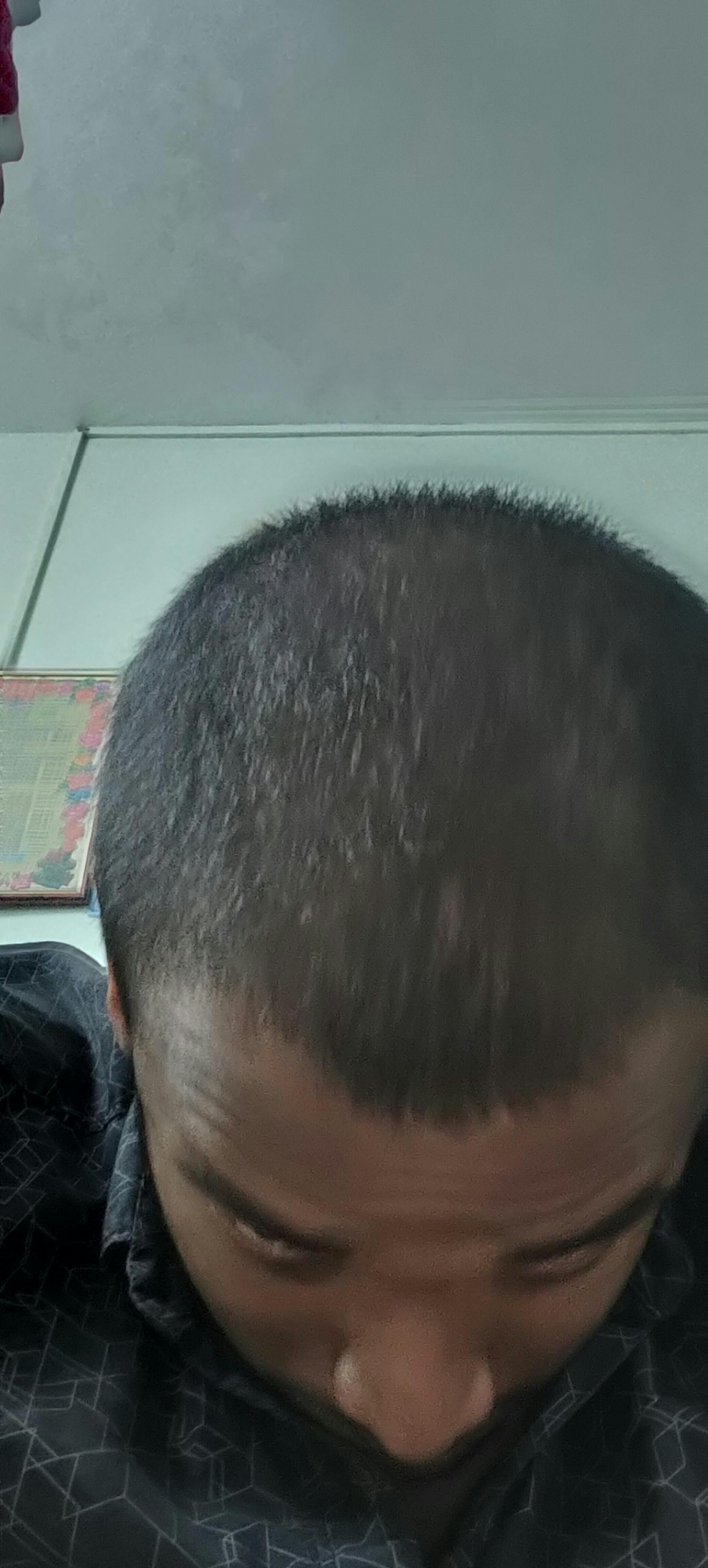 Traya hair review | Traya review | Traya Health