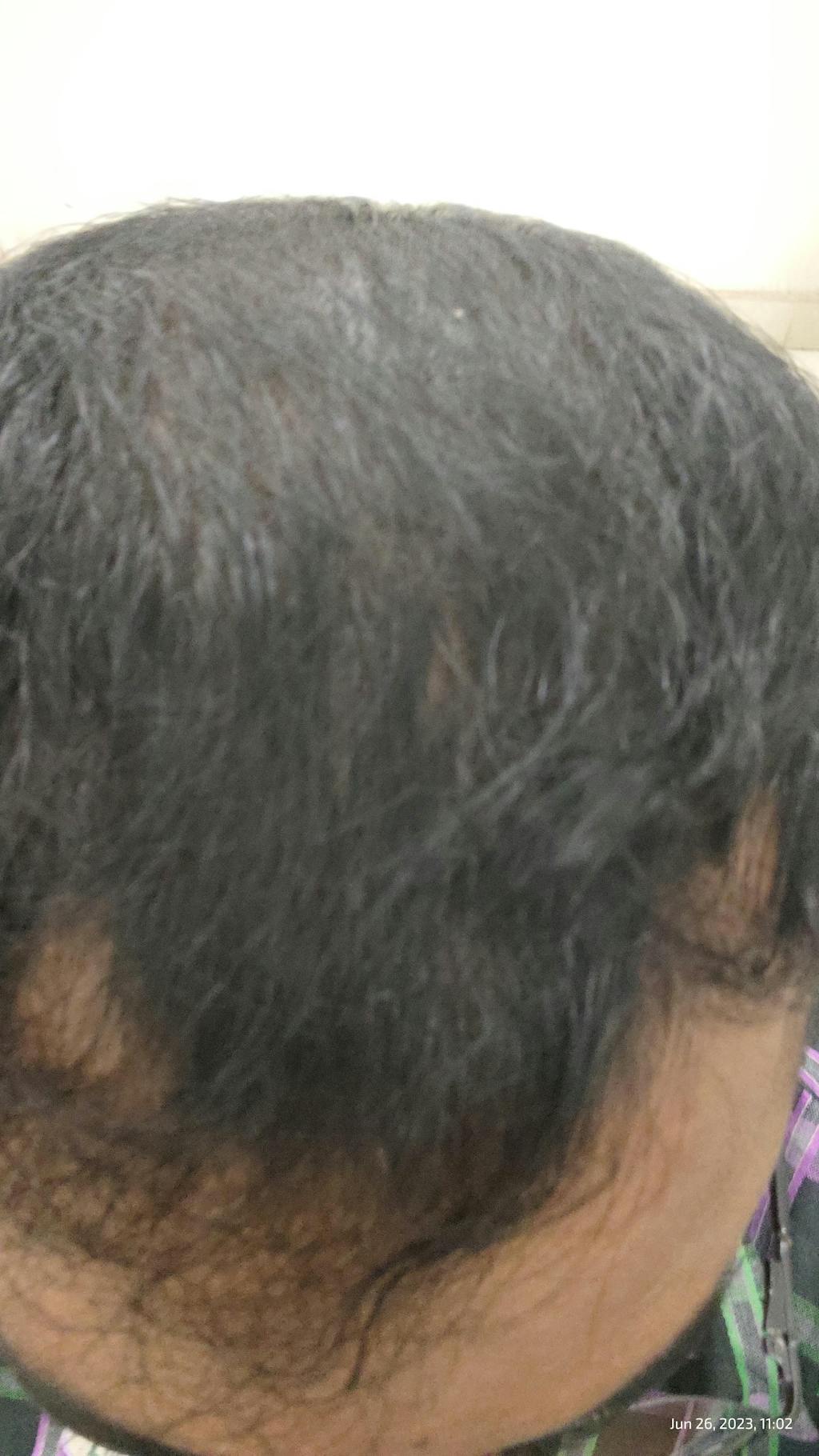 Traya hair review | Traya review | Traya Health