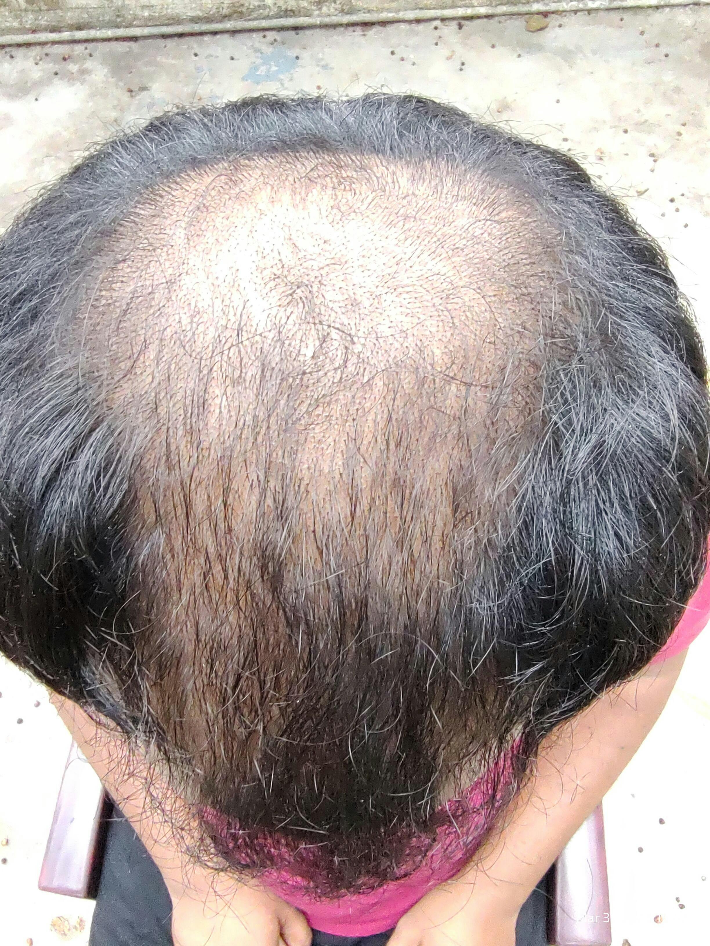 Traya hair review | Traya review | Traya Health