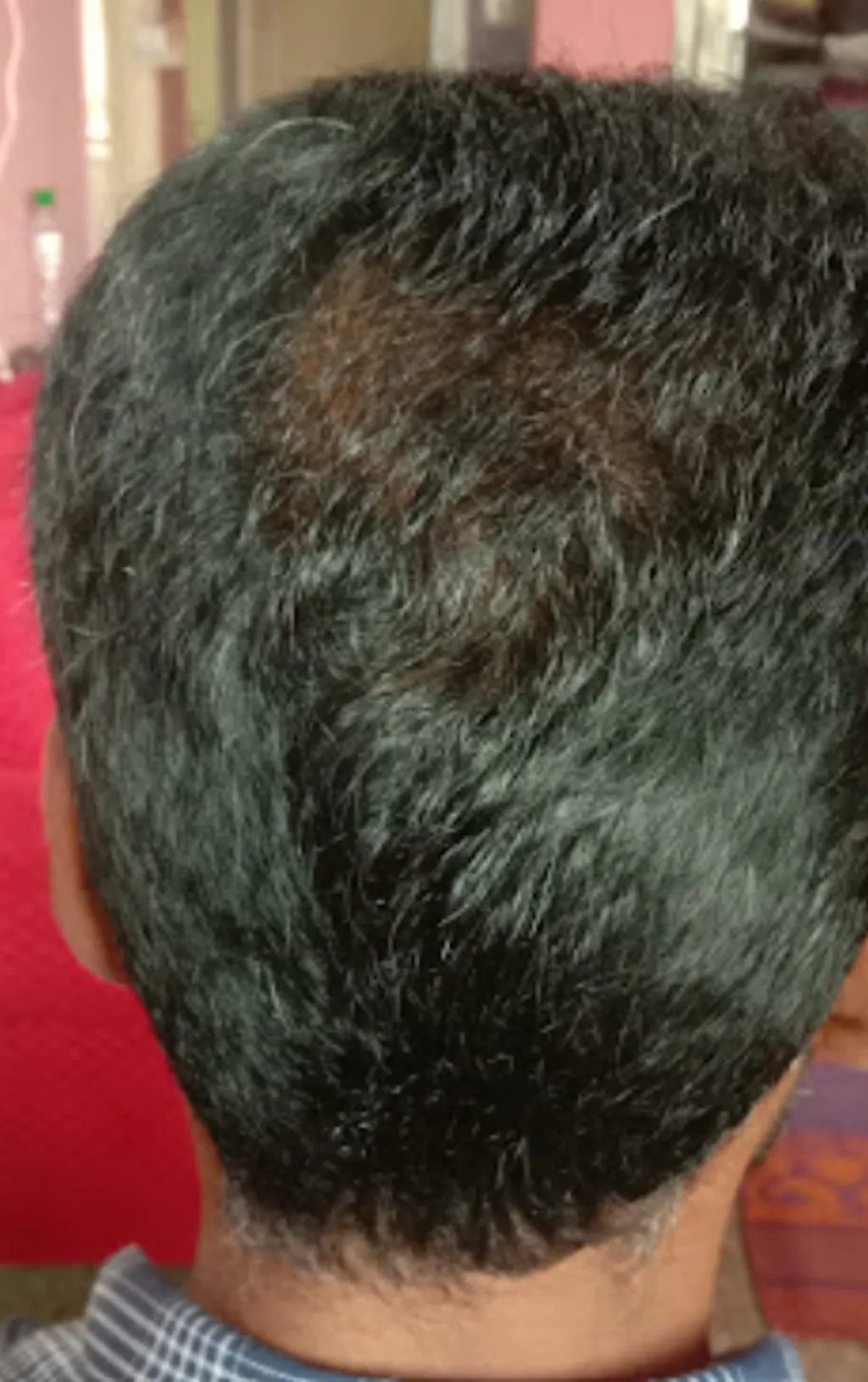Traya Hair Reviews | Real Hair Growth Stories & Testimonials