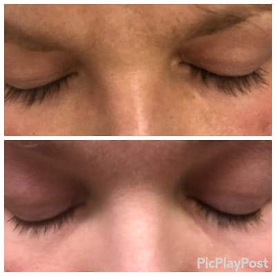 Uklash Eyelash Growth Serum for Longer, Fuller and Healthier Lashes ...