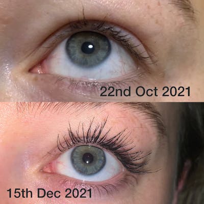 Before & After Photos – UKLASH