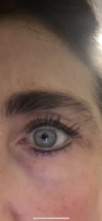 Before & After Photos – UKLASH