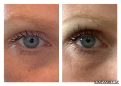 Before & After Photos – UKLASH