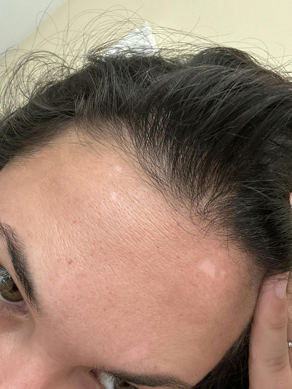 UV Derma | Leading UVB Phototherapy - Psoriasis, vitiligo, eczema