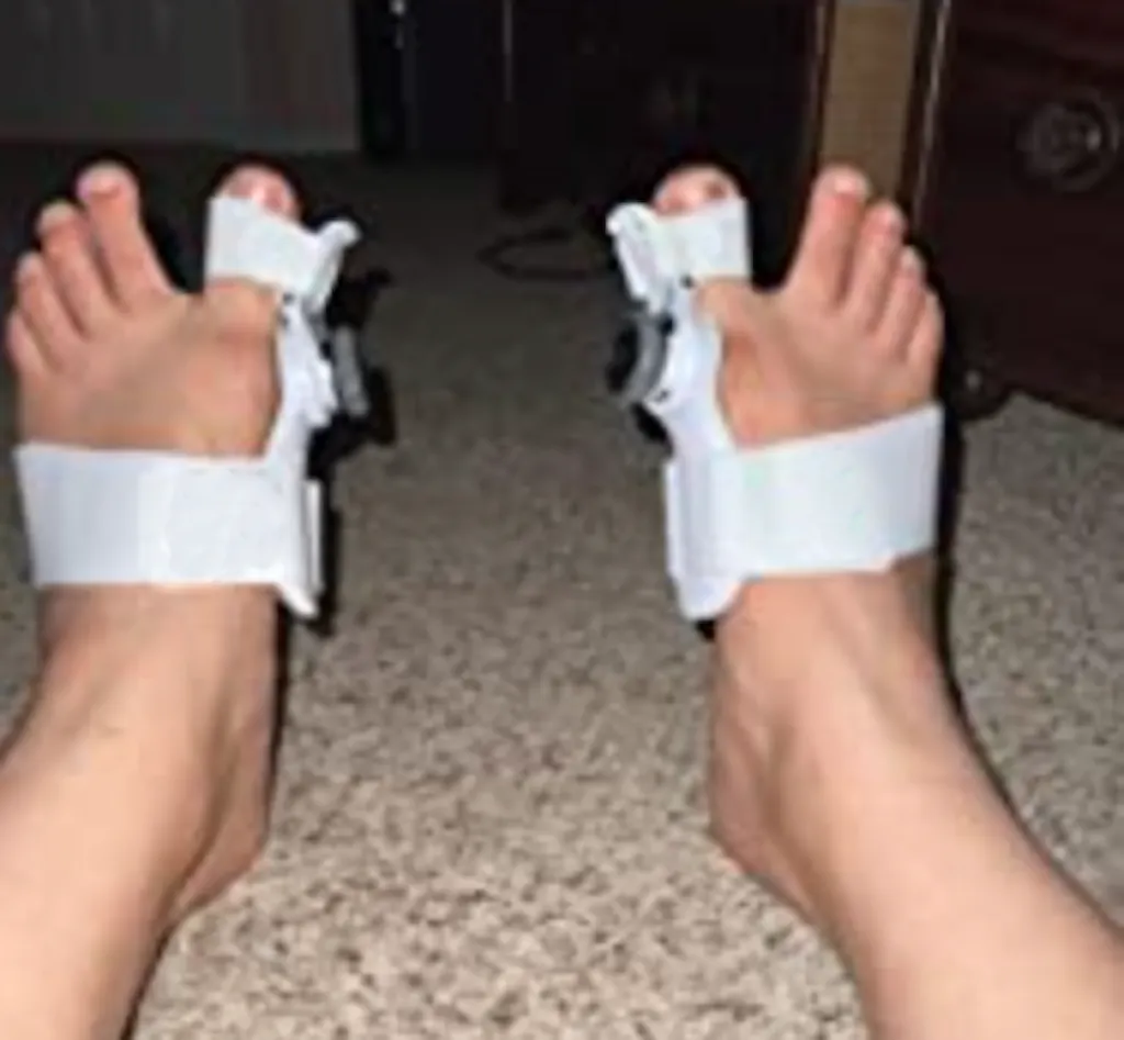 Velnem Upgraded Toe Bunion Corrector