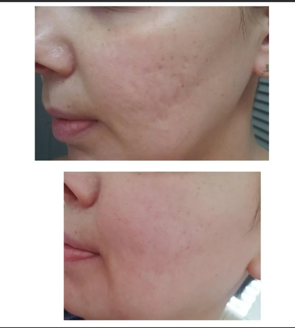 Dermatone Plasma Pen: Professional Grade, Non-Invasive Skin Treatment ...