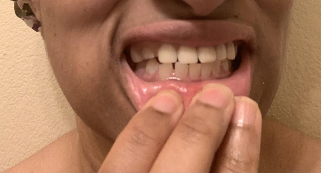 Permanently Flexible/TCS partial denture – WebDentalArt