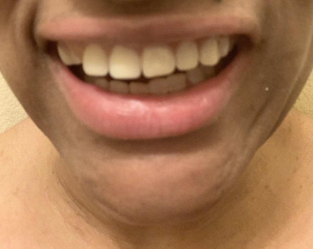 Permanently Flexible/TCS partial denture – WebDentalArt